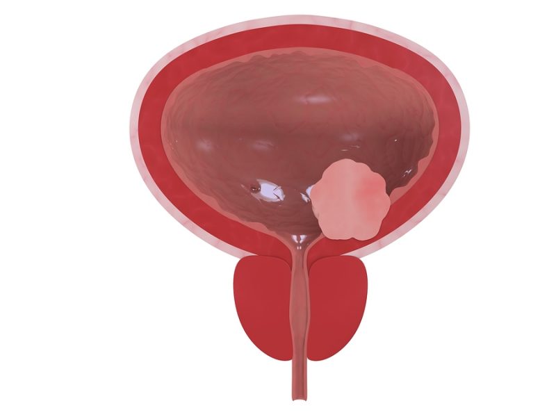 Bladder Cancer Risk Factors and Treatment - Senior Care Central